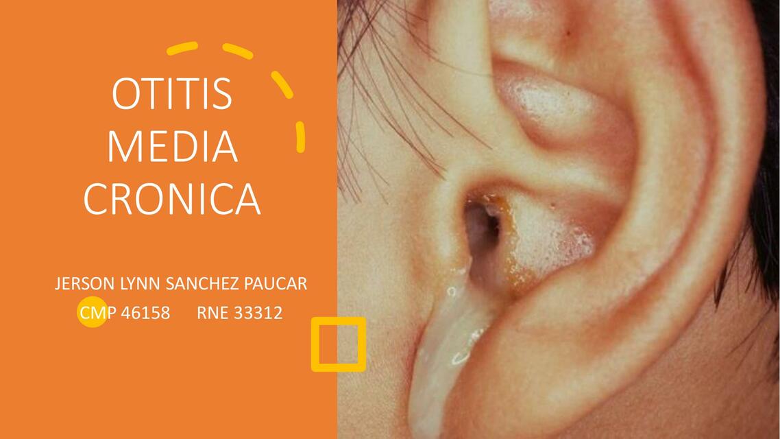 OTITIS MEDIA CRONICA | Ricky walter Cubas castillo | uDocz