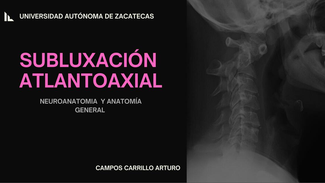 SUBLUXACIÓN ATLANTOAXIAL 3 | Arturo Campos | uDocz