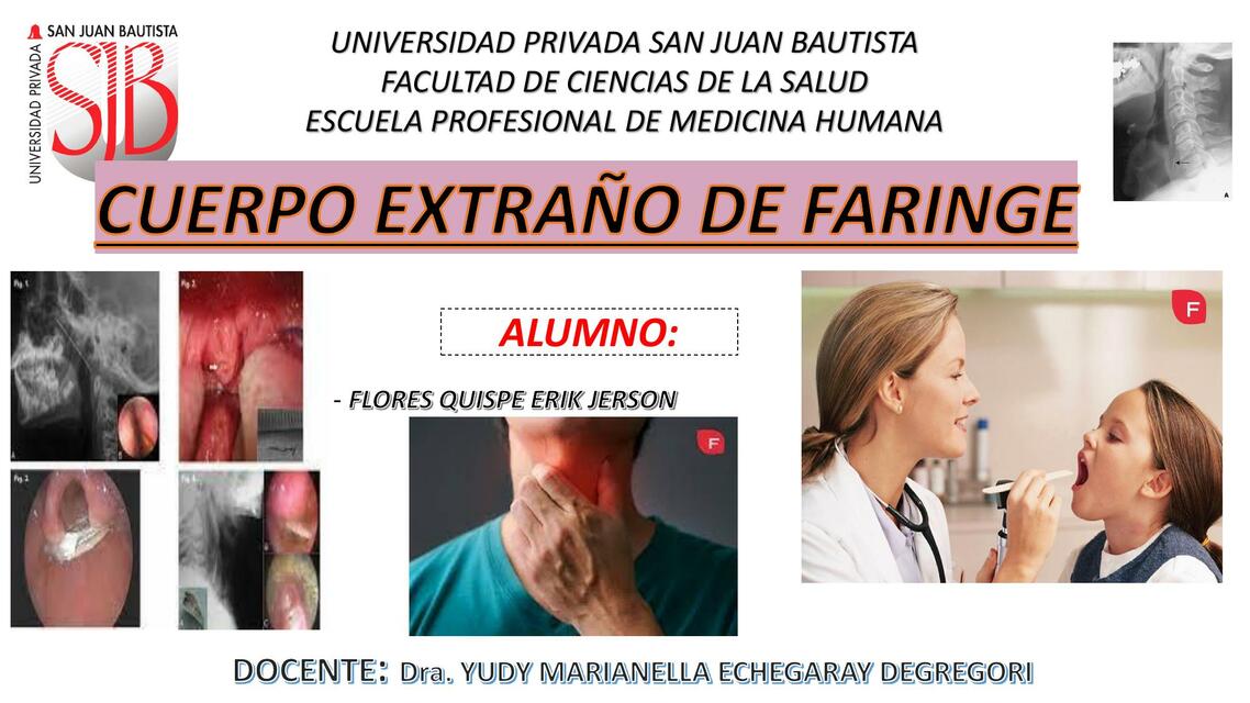 cuerpo extraño en faringe | JERSON FLORES XD | uDocz