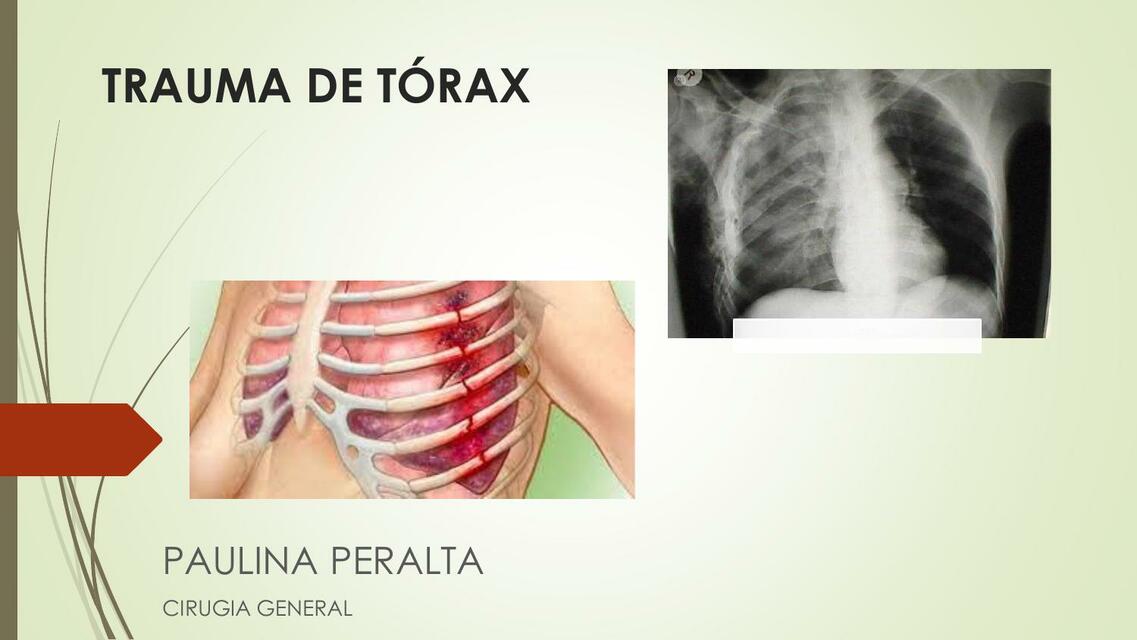 TRAUMA TORACICO /TRAUMA DE TORAX | Dra. Pau Peralta | uDocz