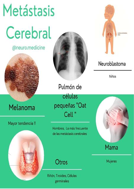 Metástasis Cerebral | NeuroMedicine | uDocz