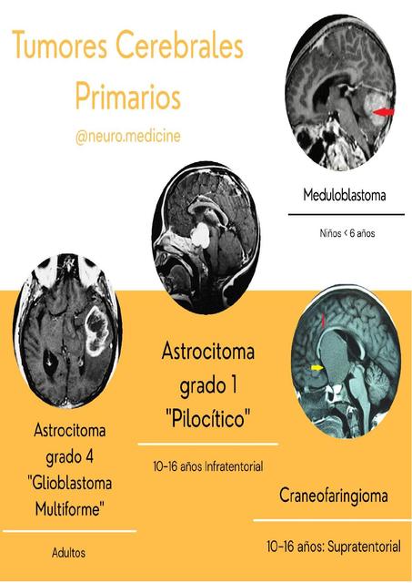 Tumores Cerebrales Primarios | NeuroMedicine | uDocz