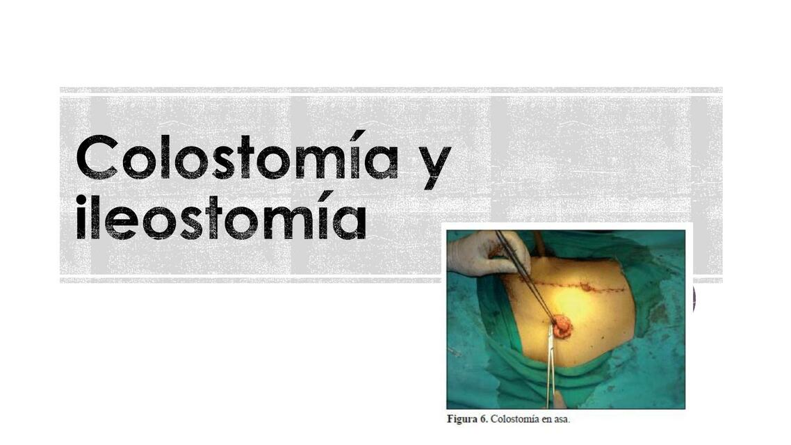 colostomia | Fatima Lopez Cabañas | uDocz