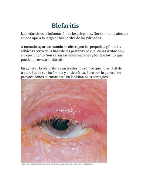Blefaritis | Aura Ester Peréz Rada | uDocz