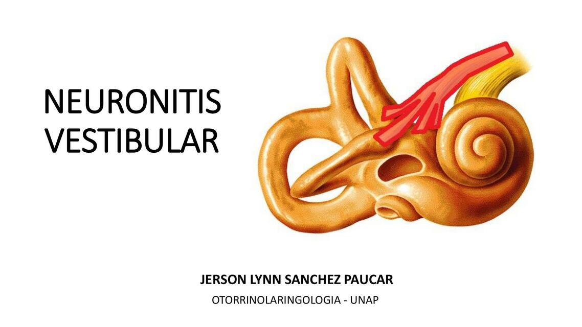 6 3NEURITIS VESTIBULAR | Ricky walter Cubas castillo | uDocz