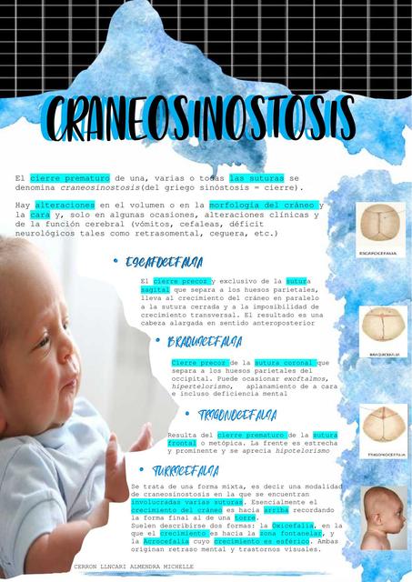 Craneosinostosis | Almendra Michelle Cerrón Llancari | uDocz