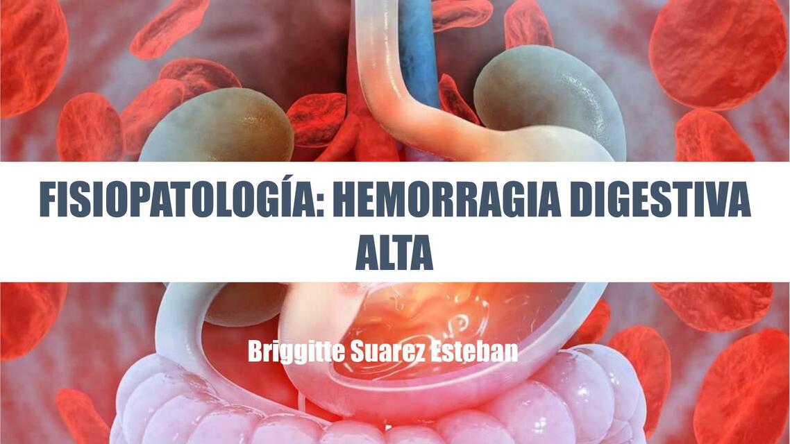Fisiopatología de la Hemorragia Digestiva | Briggitte Yamilé Suarez ...