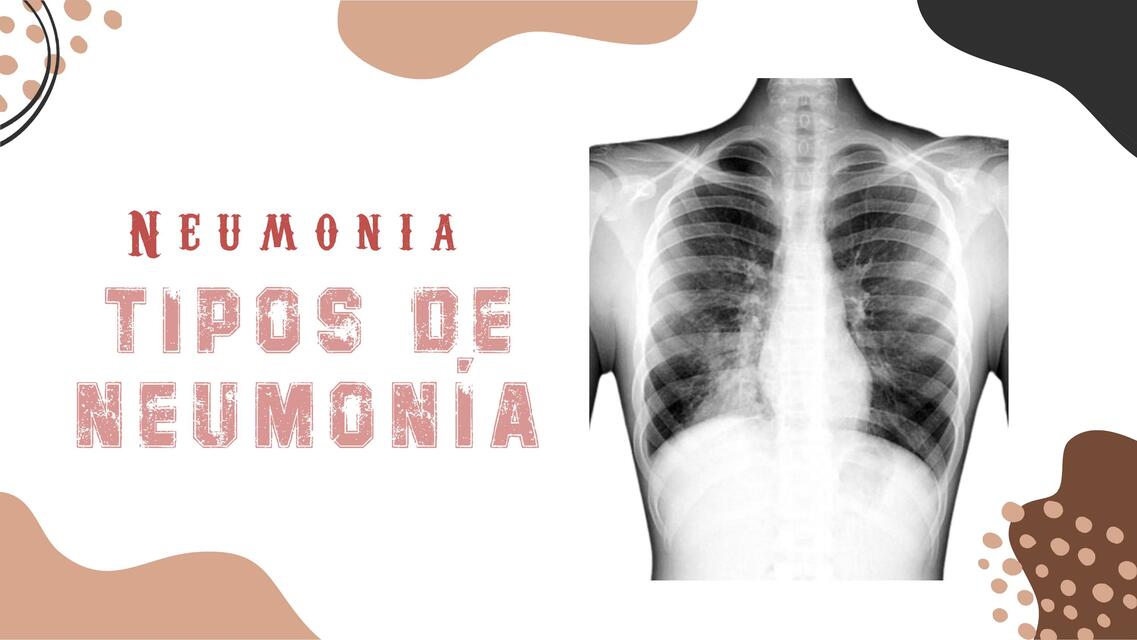 TIPOS DE NEUMONIA RX | uDocz