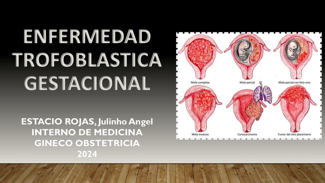 Enfermedad trofoblástica gestacional | Julinho Angel Estacio Rojas | uDocz