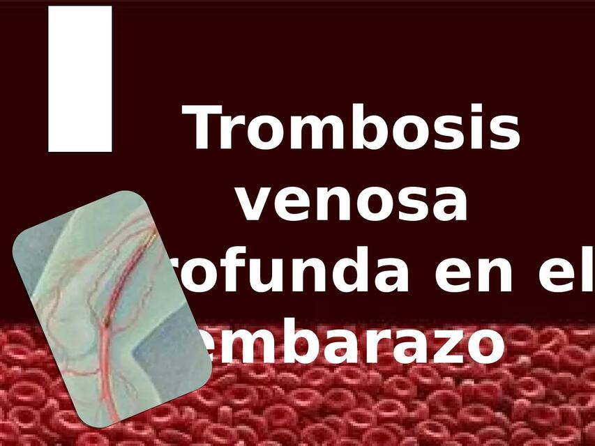 Trombosis venosa profunda en el embarazo | Norjeilys | uDocz