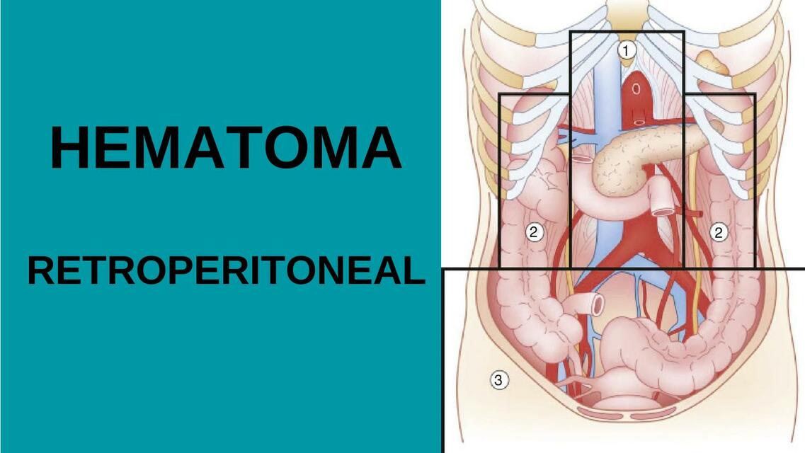 HEMATOMA RETROPERITONEAL | Villar Chavez | uDocz