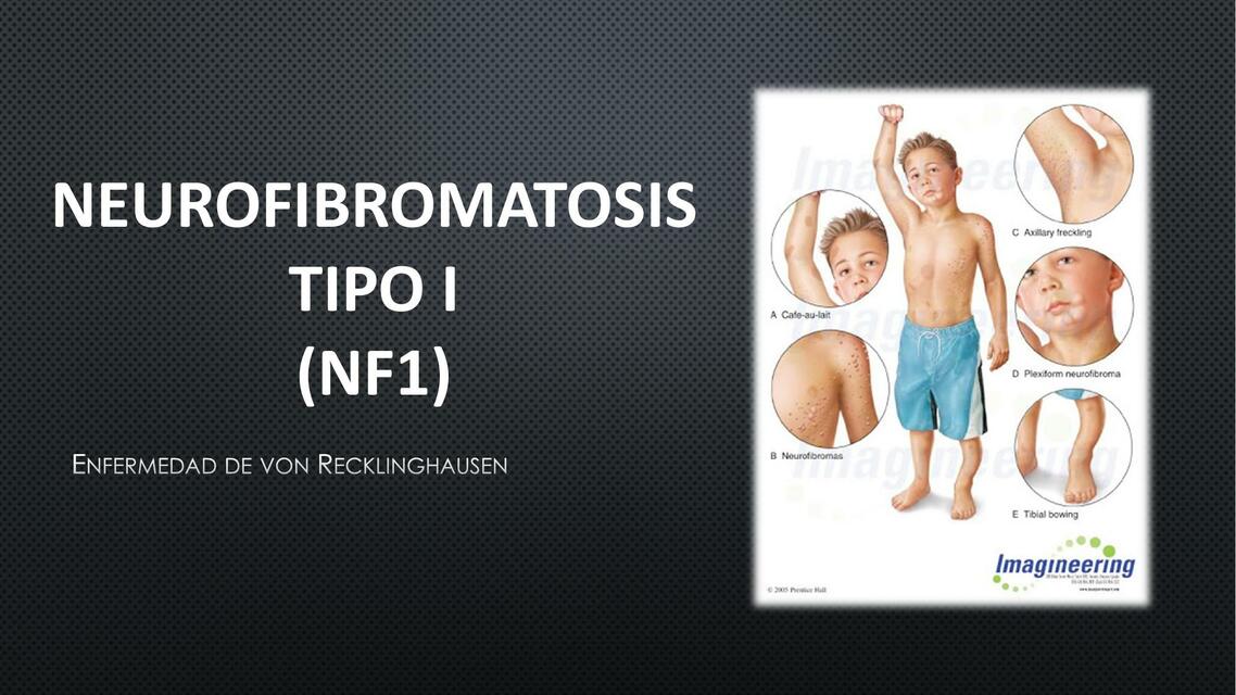 NEUROFIBROMATOSIS TIPO I | Sebastian Martín | uDocz