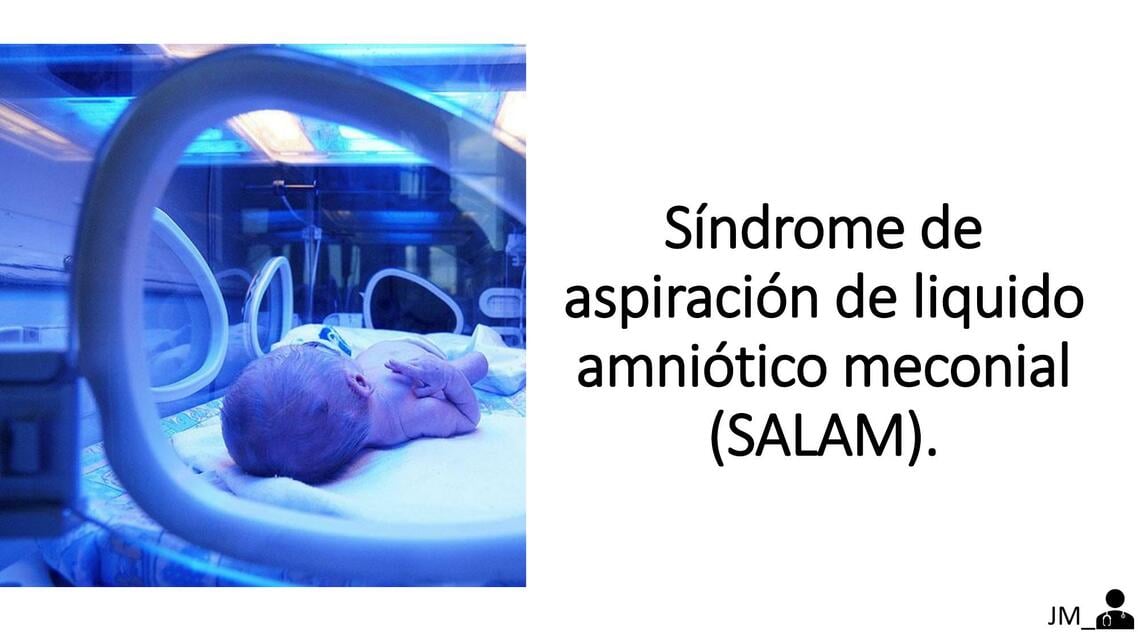 Síndrome de aspiración de liquido amniótico meconial | José Mendoza | uDocz