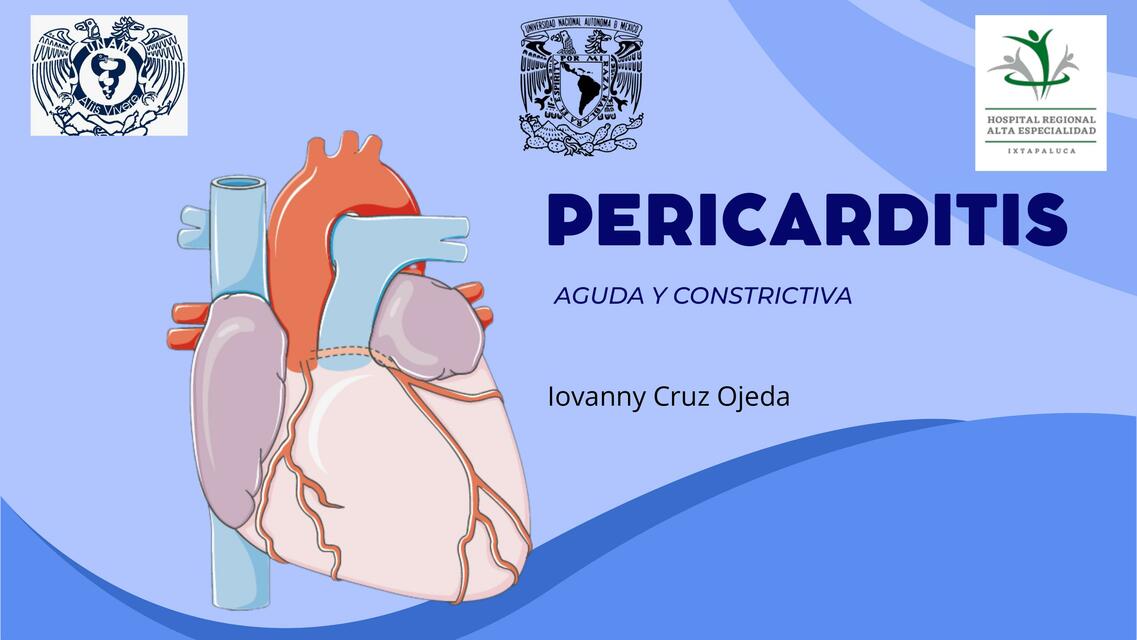 Pericarditis | IOVANNY CRUZ OJEDA | uDocz