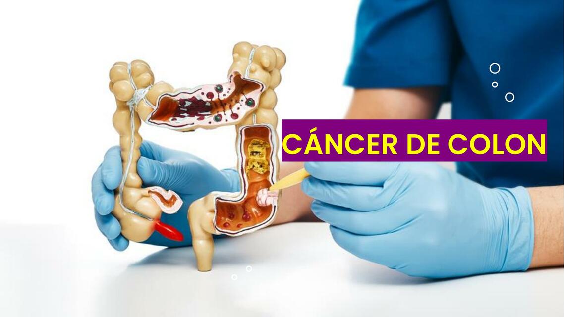 Cáncer de colon | Bethel Heredia | uDocz