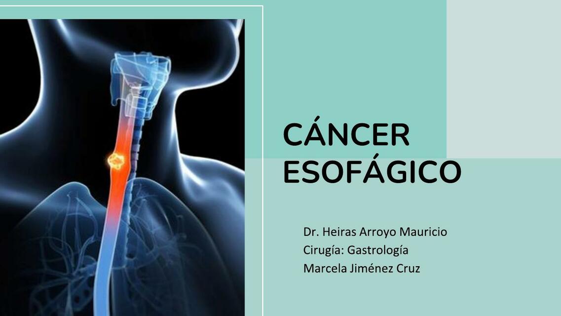 CÁNCER ESOFÁGICO | lizeth salas | uDocz