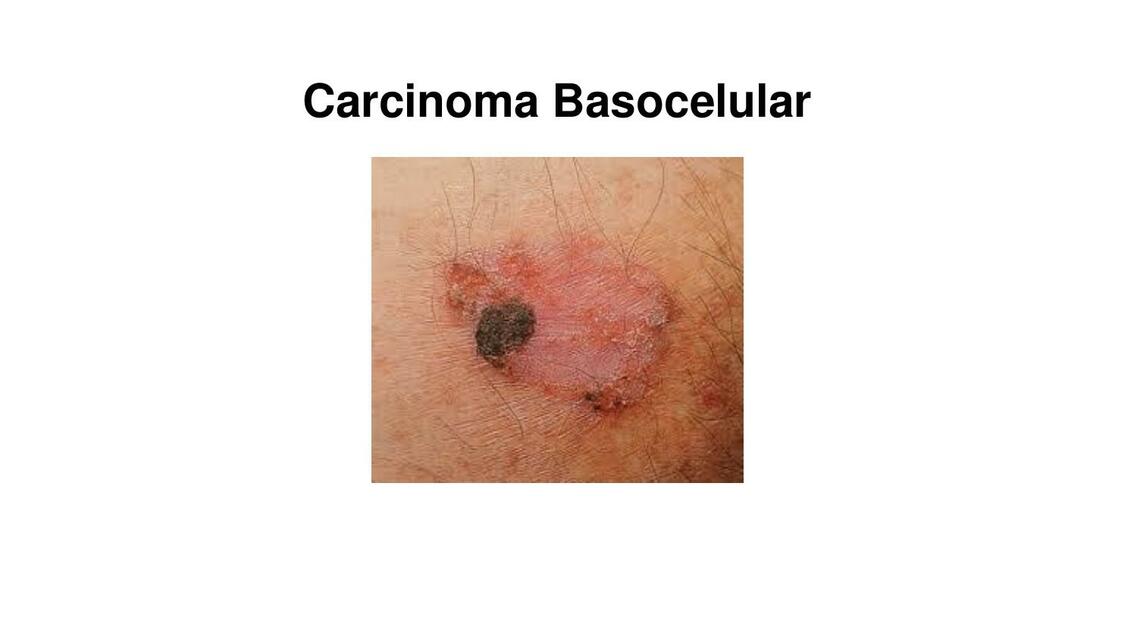 ppt carcinoma basocelular | ALMENDRA ISABEL OROYA OBANDO | uDocz