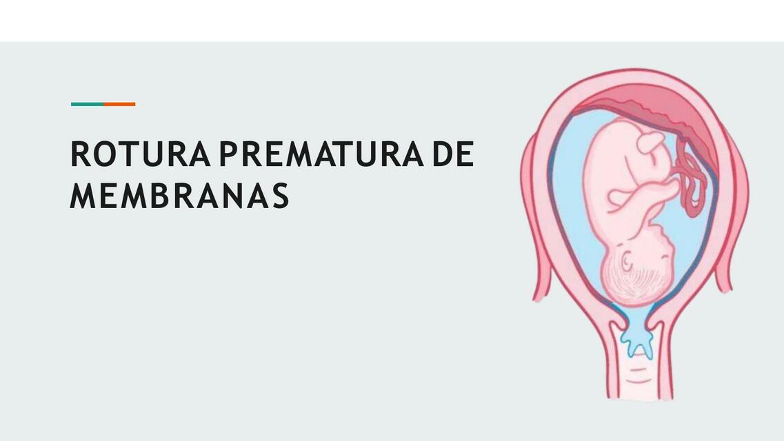 ROTURA PREMATURA DE MEMBRANAS 1 1 | Mijael | uDocz